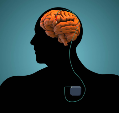 New Study Further Personalizes Deep Brain Stimulation | Parkinson's ...
