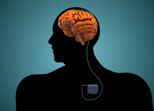 New Continuous Pump Medication for Parkinson’s Completes Trials in ...