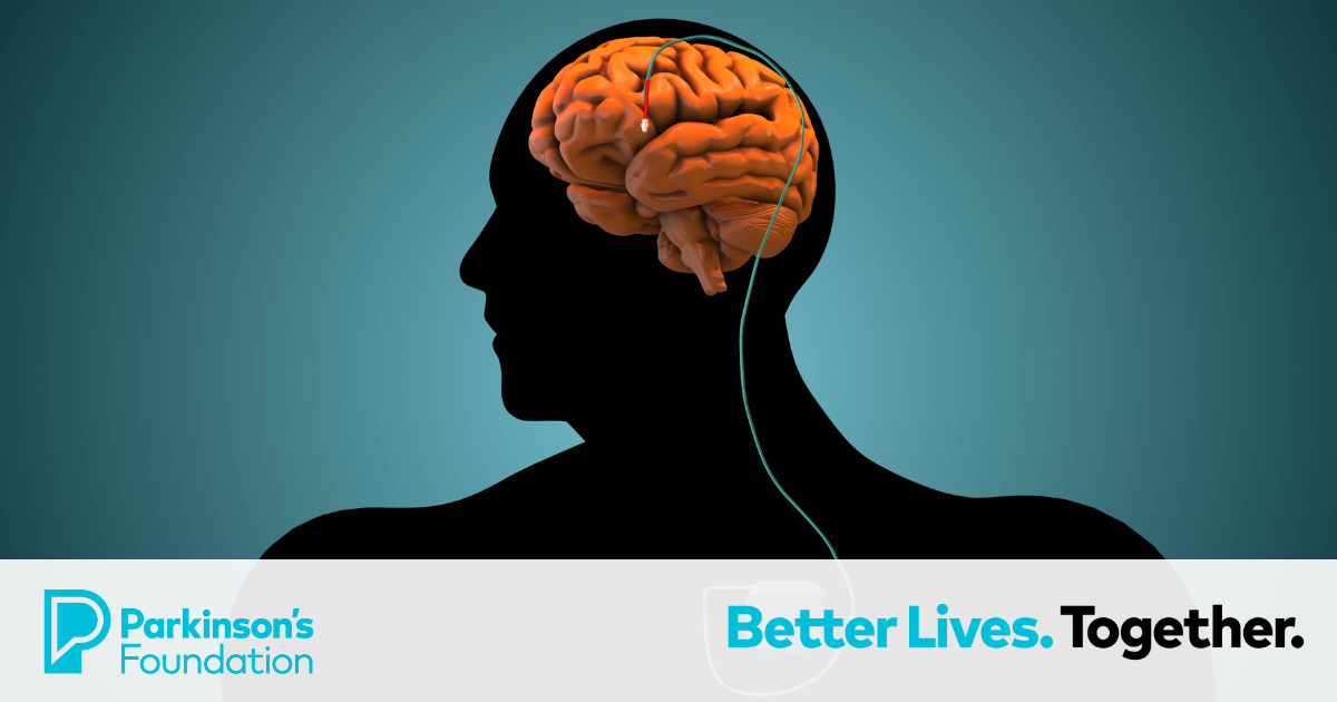 New Study Further Personalizes Deep Brain Stimulation | Parkinson's ...